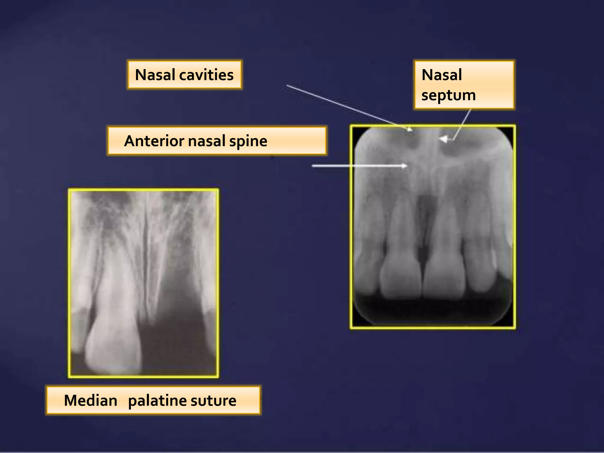 Normal Radiographic Anatomical Landmarks | PPTX