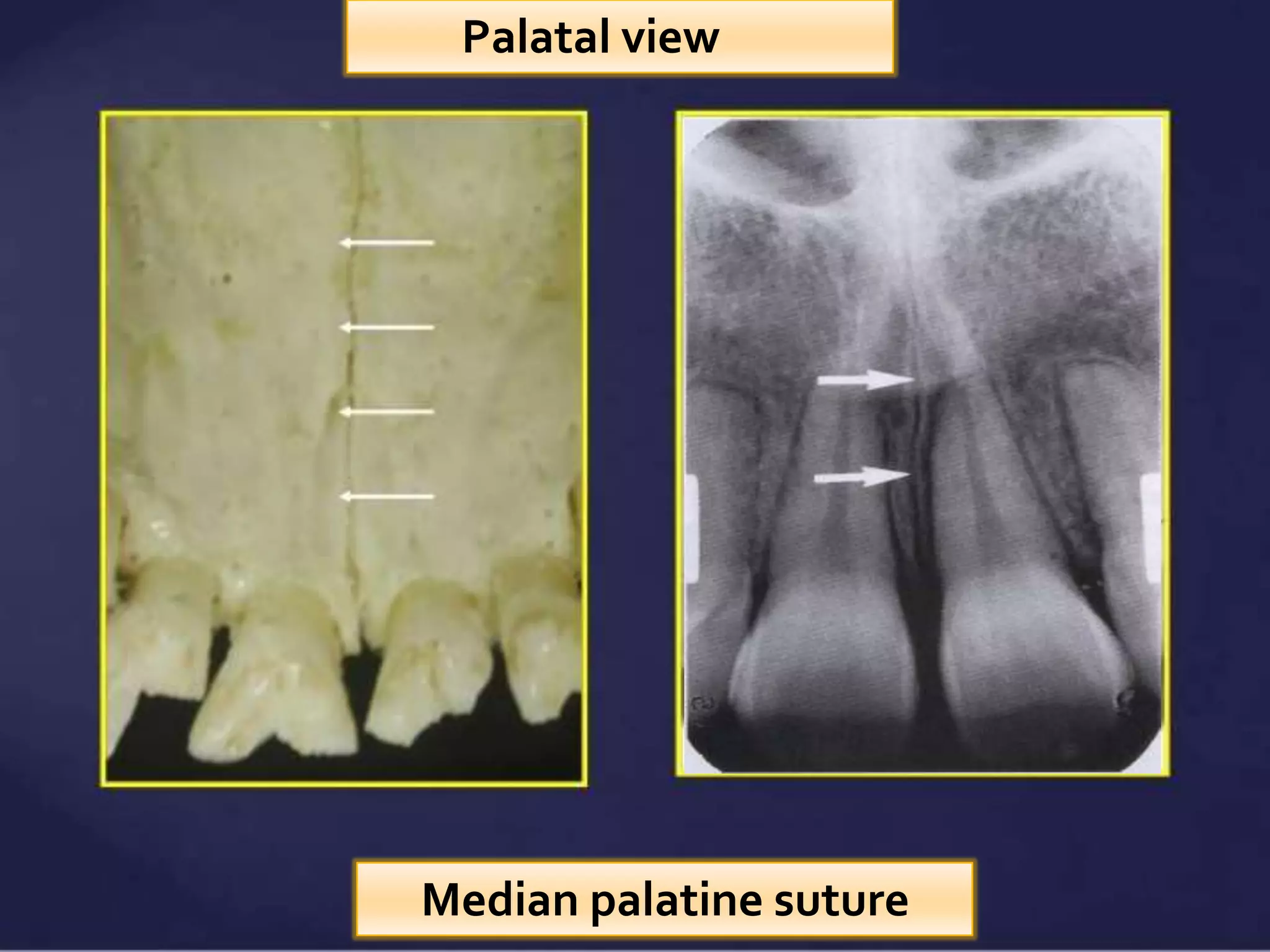 Normal Radiographic Anatomical Landmarks | PPTX
