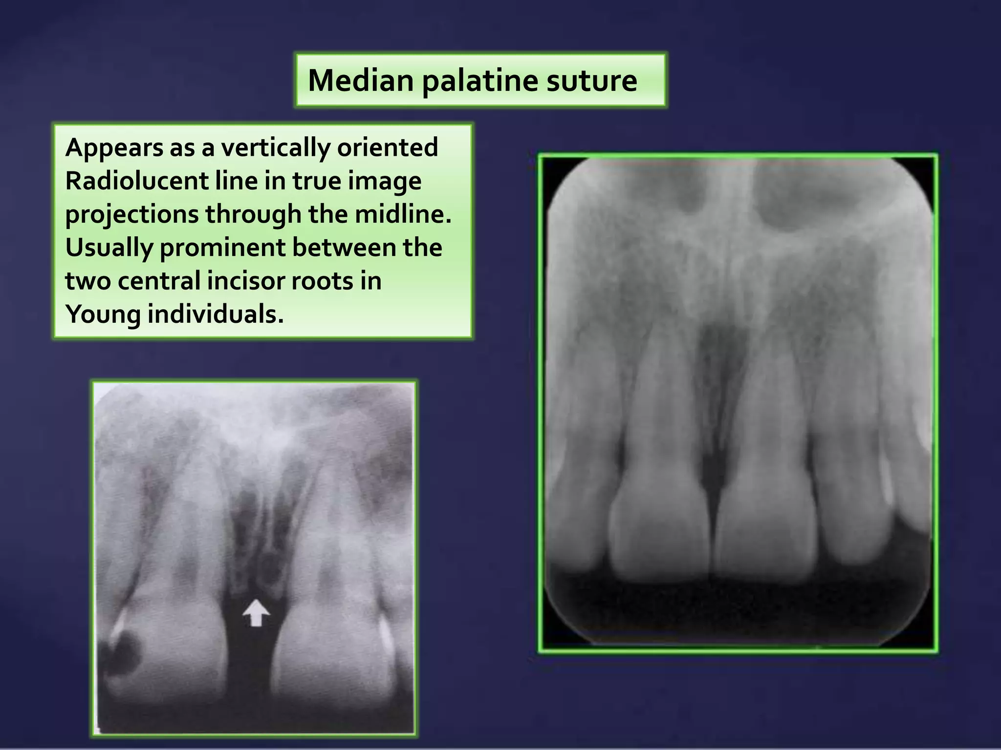 Normal Radiographic Anatomical Landmarks | PPTX