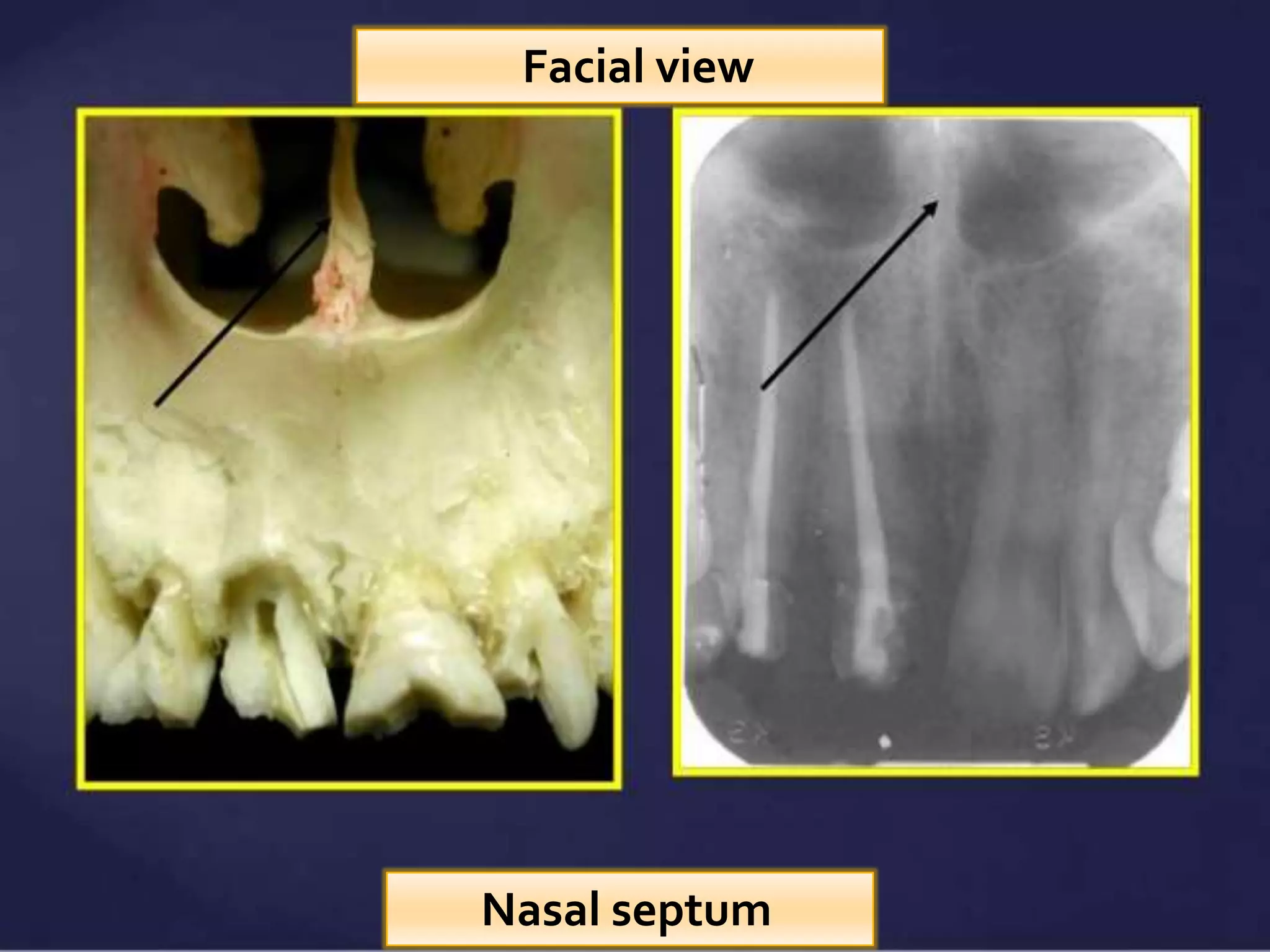 Normal Radiographic Anatomical Landmarks | PPTX