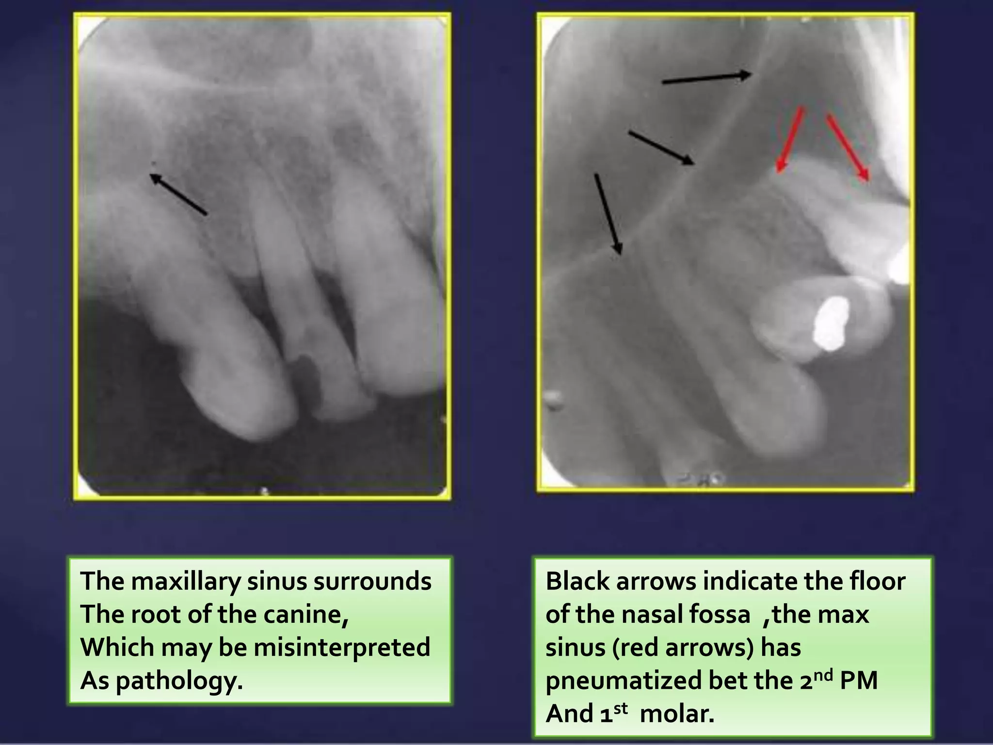 Normal Radiographic Anatomical Landmarks | PPTX