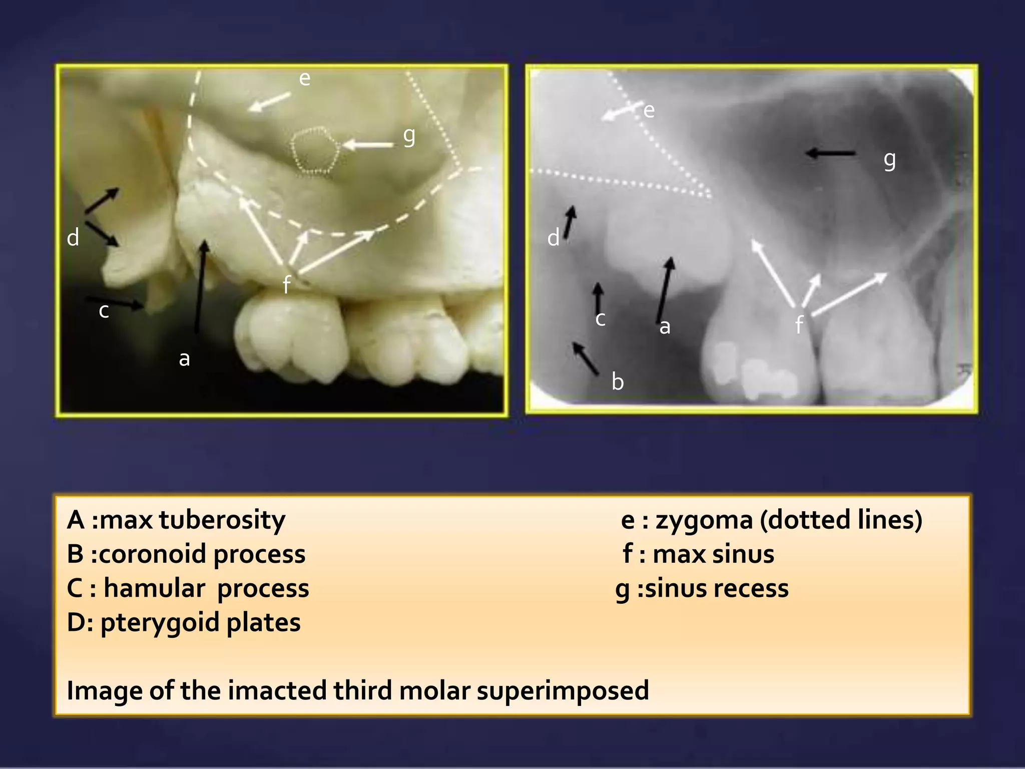 Normal Radiographic Anatomical Landmarks | PPTX