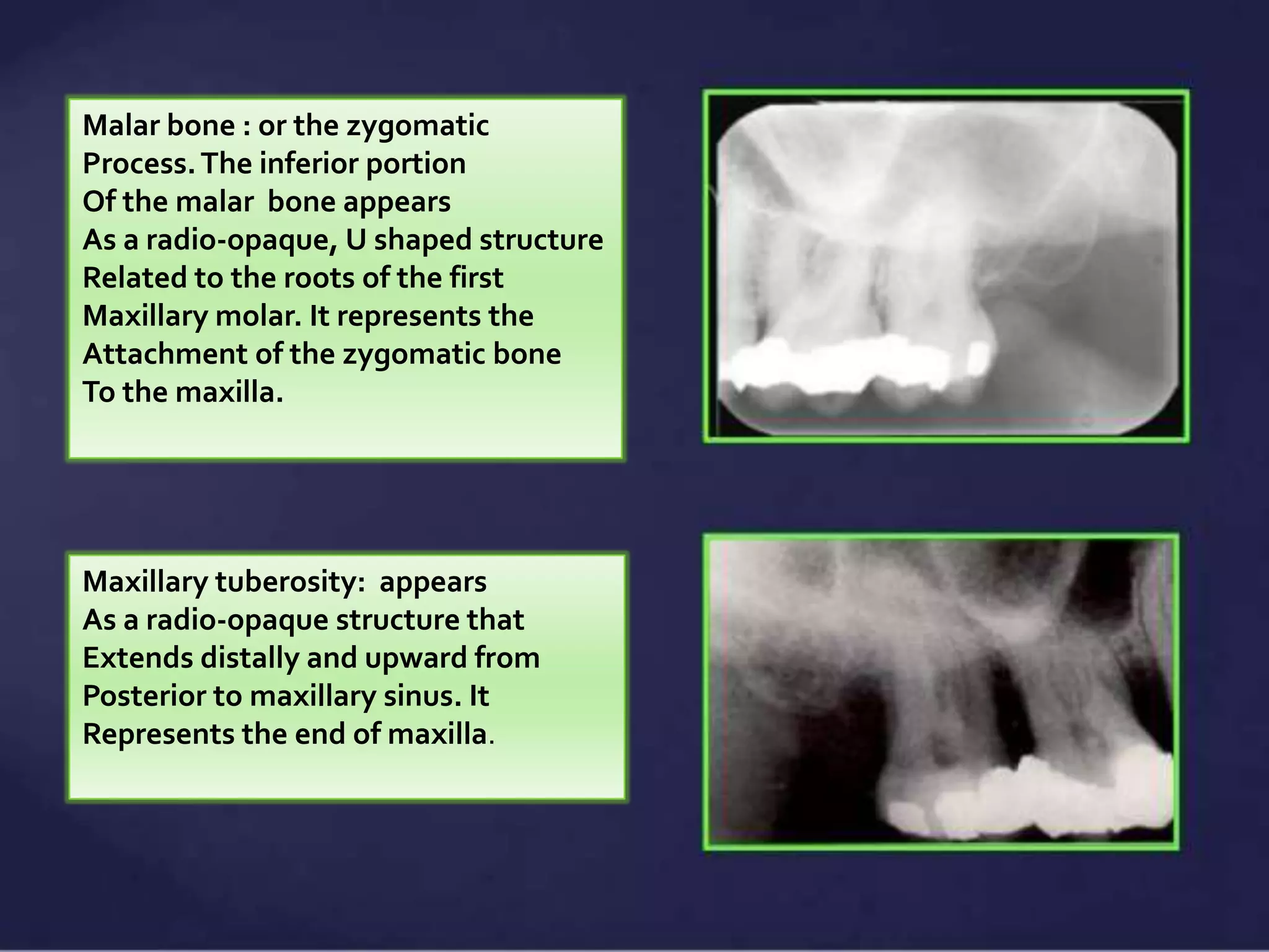 Normal Radiographic Anatomical Landmarks | PPTX
