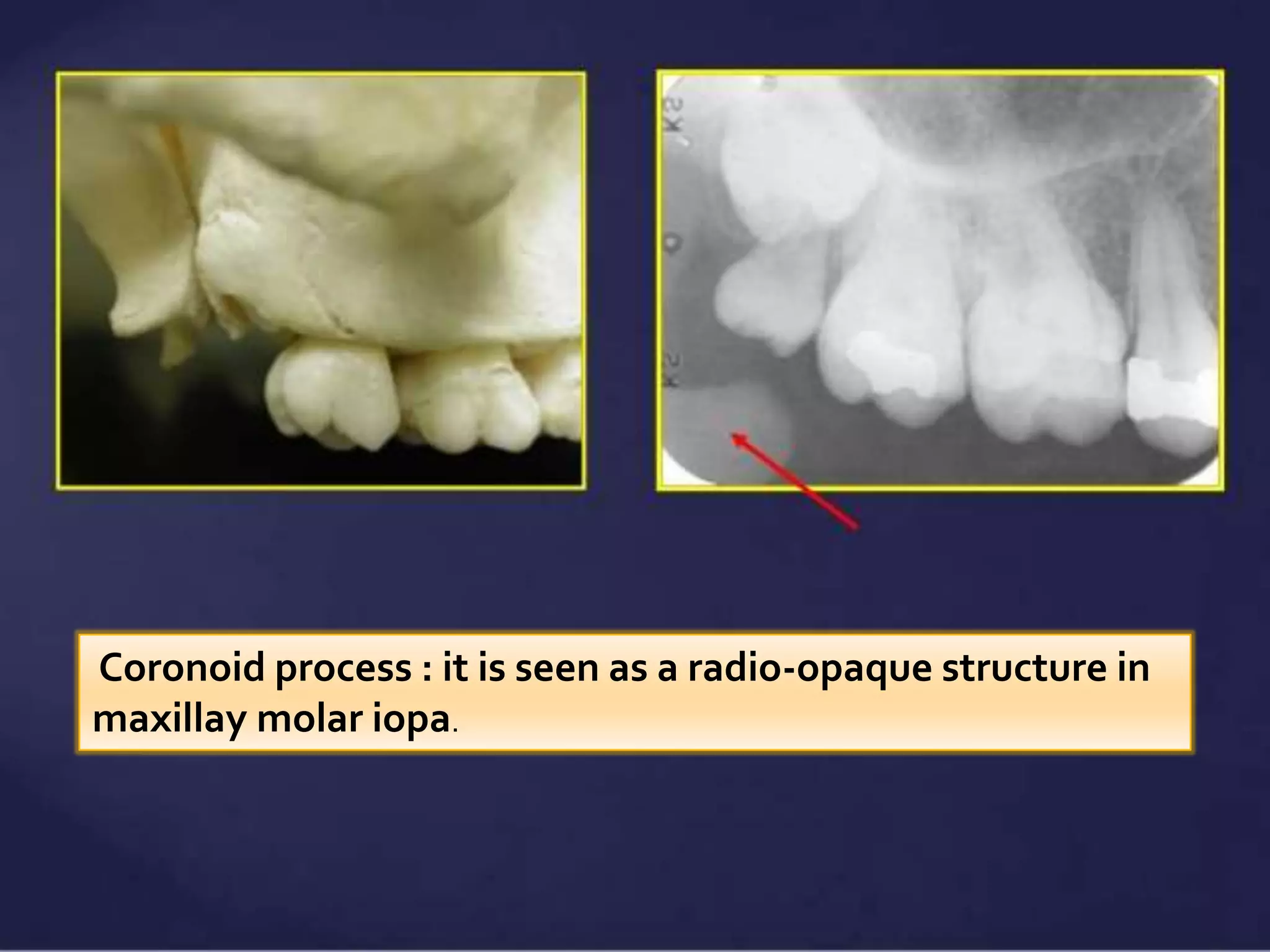 Normal Radiographic Anatomical Landmarks | PPTX