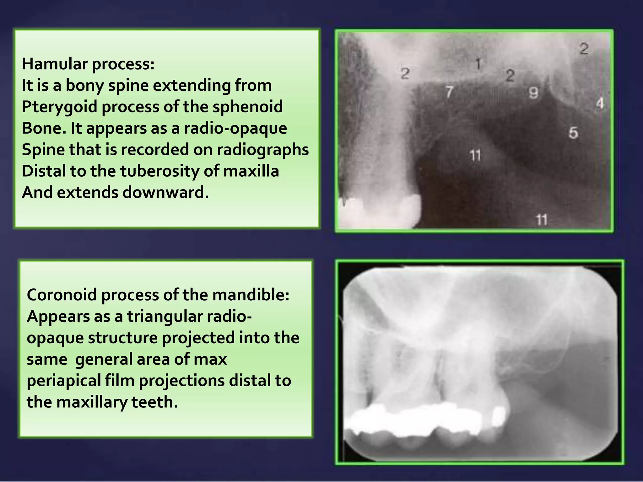 Normal Radiographic Anatomical Landmarks | PPTX