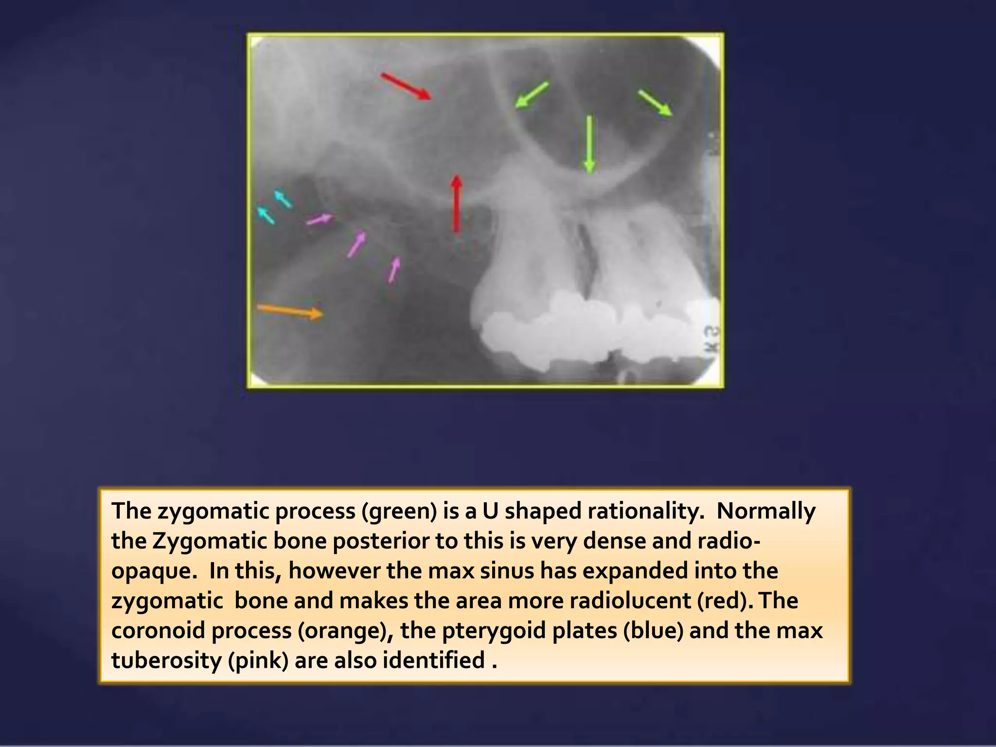 Normal Radiographic Anatomical Landmarks | PPTX