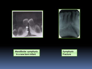 Submandibular Fossa Radiograph