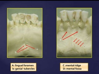Lingual Foramen And Genial Tubercle