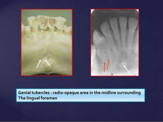 Normal Radiographic Anatomical Landmarks | PPTX