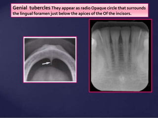 Lingual Foramen And Genial Tubercle