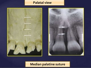 Intermaxillary Suture Radiograph
