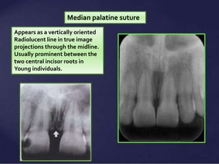Intermaxillary Suture Radiograph