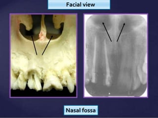 Mental Fossa Radiograph