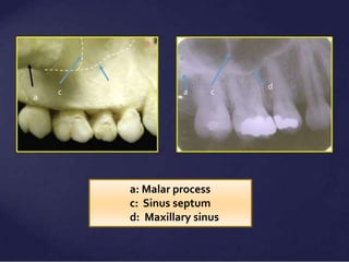 Hamular Process Radiography