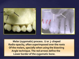 Zygomatic Process Of Maxilla Radiograph