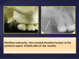 Maxillary Tuberosity Radiograph