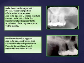 Maxillary Tuberosity Radiograph