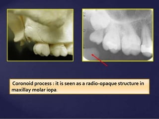Coronoid Process Radiography