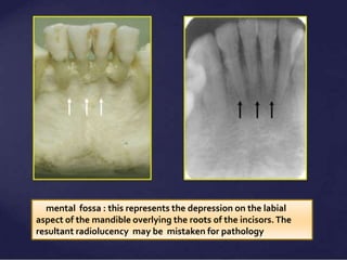 Mental Fossa Radiograph