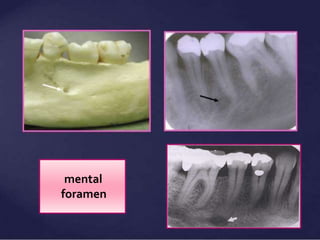 Mylohyoid Ridge Radiograph