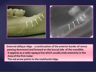 Mylohyoid Ridge Radiograph