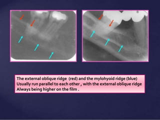 Internal Oblique Ridge Radiograph