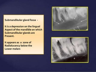 Submandibular Fossa Radiograph
