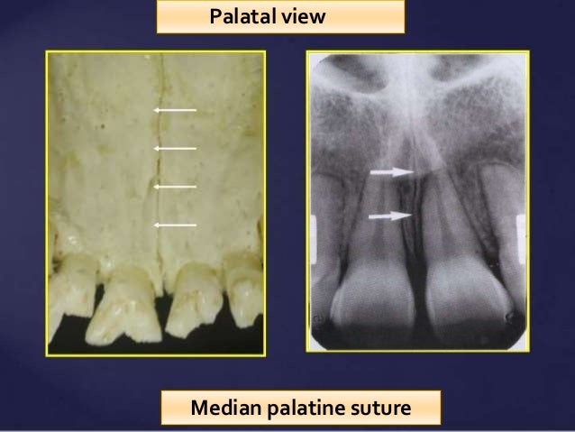Normal Radiographic Anatomical Landmarks