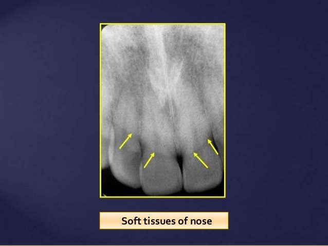 Normal Radiographic Anatomical Landmarks