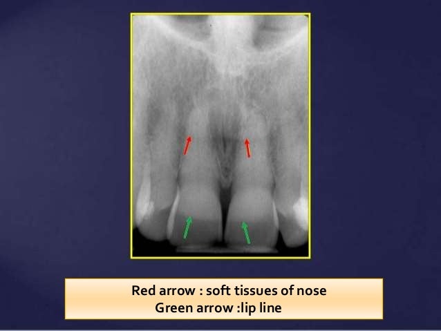 Normal Radiographic Anatomical Landmarks