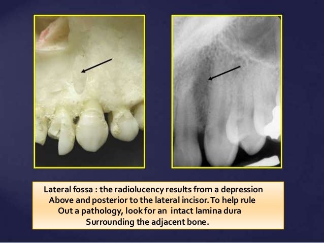 Normal Radiographic Anatomical Landmarks