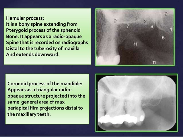 Hamular Process