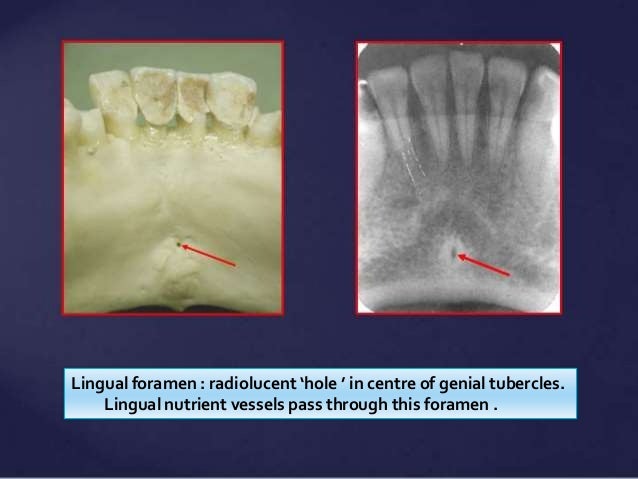 Lingual Foramen And Genial Tubercle 22 Recognizing Normal Radiographic
