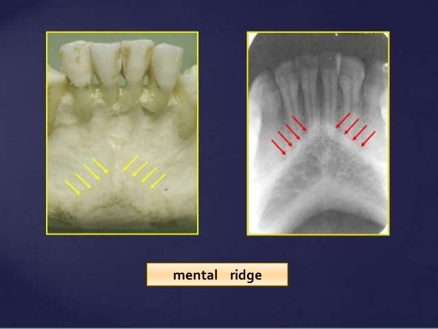 Normal Radiographic Anatomical Landmarks