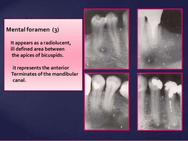 Mental Fossa Radiograph