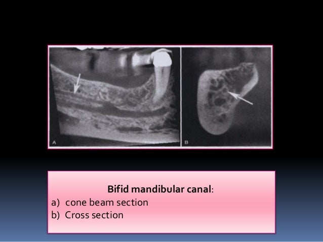 Submandibular Fossa