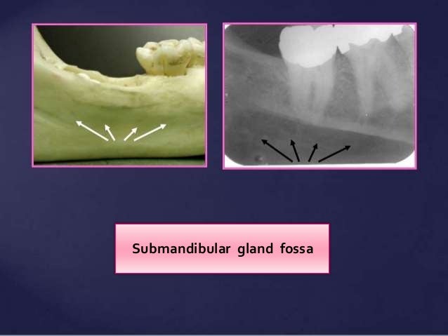 Submandibular Fossa