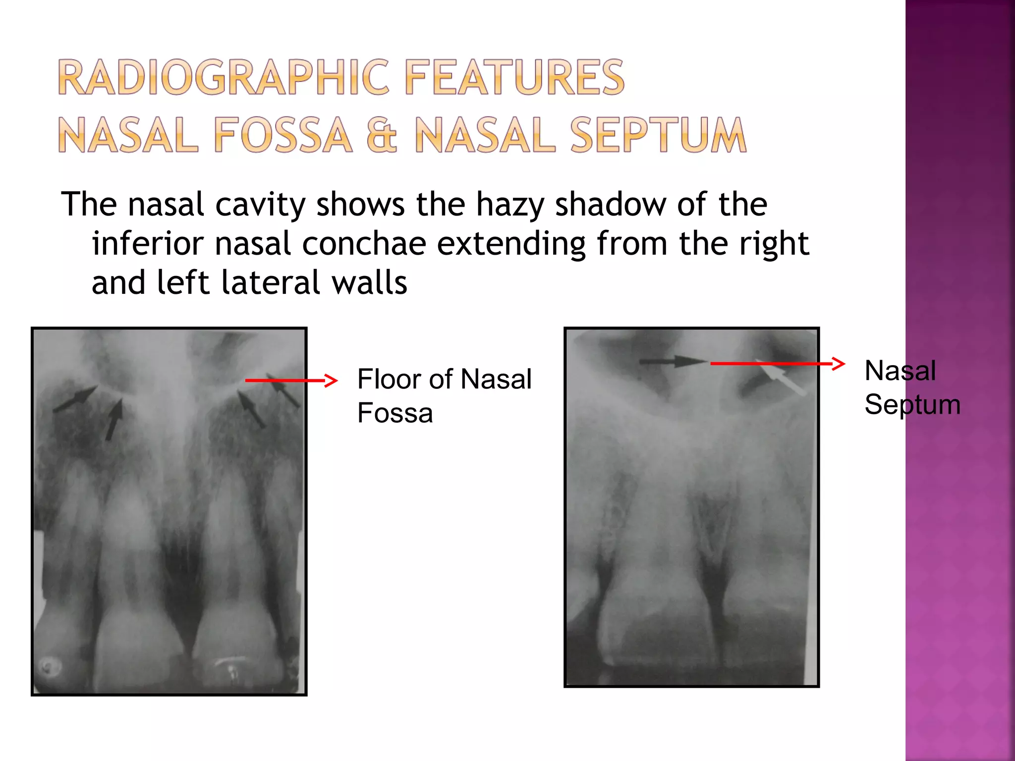 NORMAL ANATOMIC LANDMARKS ; PRICHARDS CRITERIA ; NORMAL INTERDENTAL ...