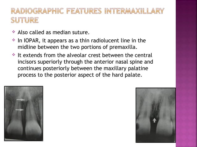 NORMAL ANATOMIC LANDMARKS ; PRICHARDS CRITERIA ; NORMAL INTERDENTAL ...
