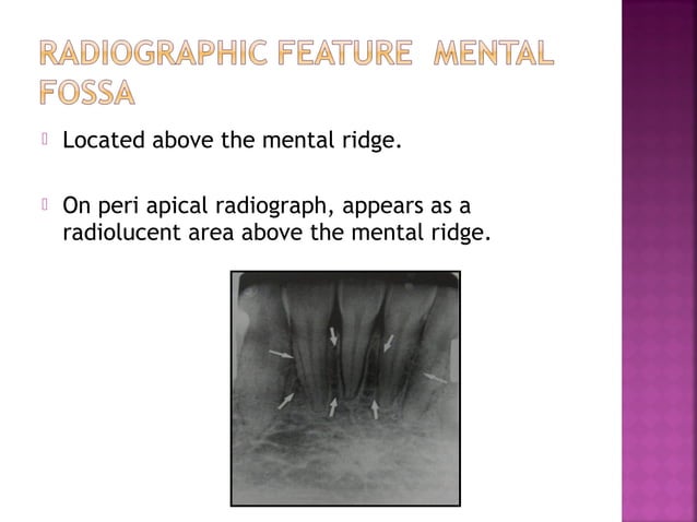 NORMAL ANATOMIC LANDMARKS ; PRICHARDS CRITERIA ; NORMAL INTERDENTAL ...