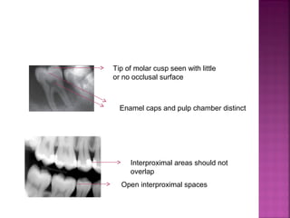 NORMAL ANATOMIC LANDMARKS ; PRICHARDS CRITERIA ; NORMAL INTERDENTAL ...
