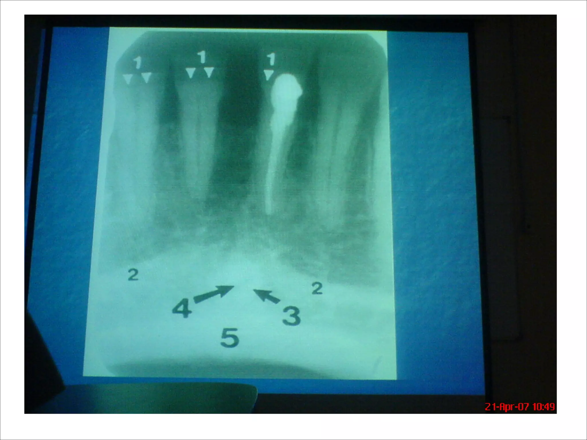Normal Radiographic Anatomy | PPT