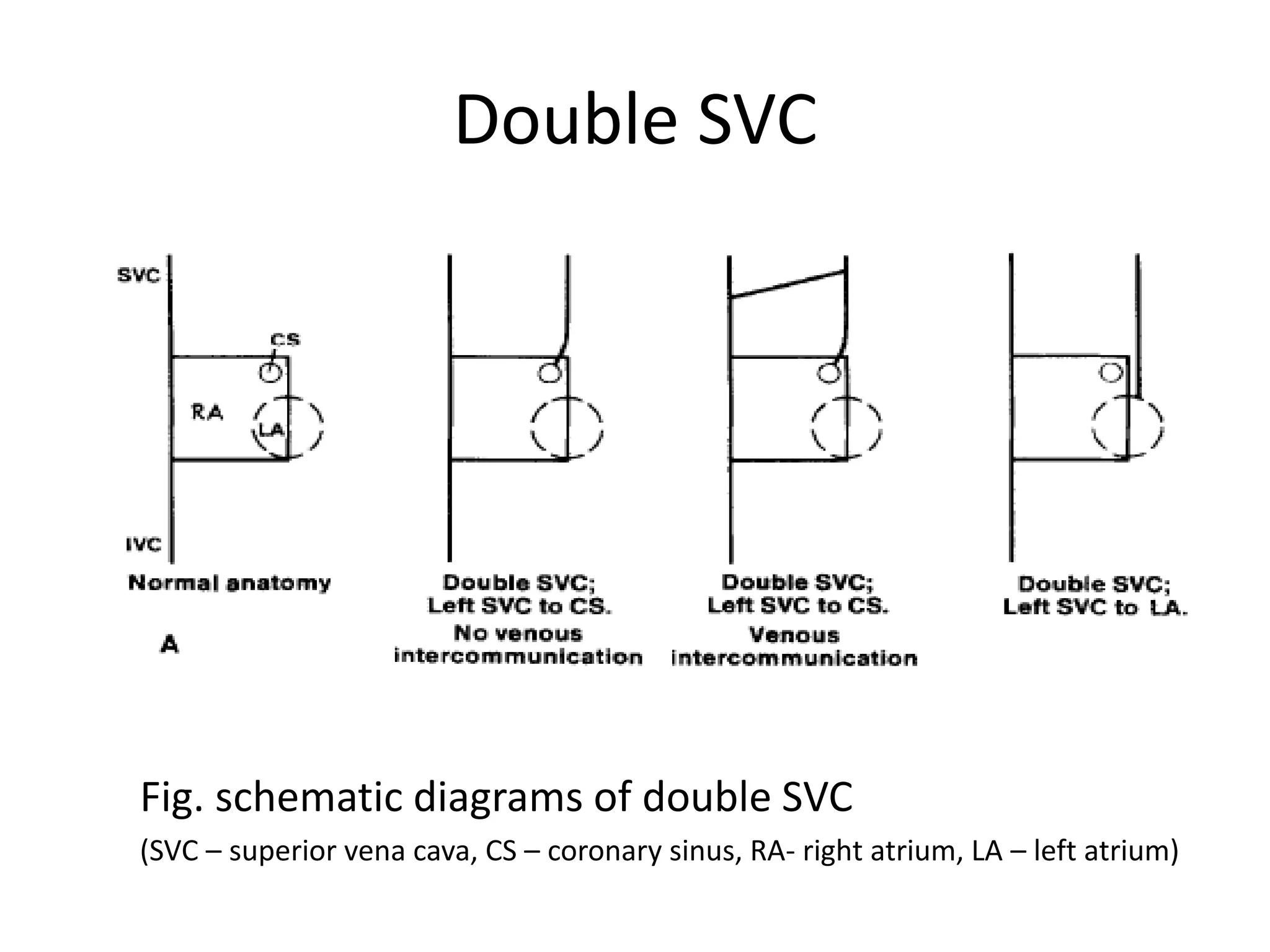 Normal anatomy and congenital anomalies of vena cavae | PPTX