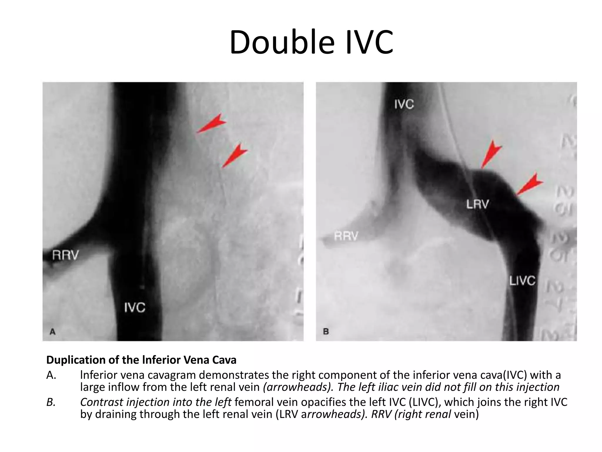 Normal anatomy and congenital anomalies of vena cavae | PPTX