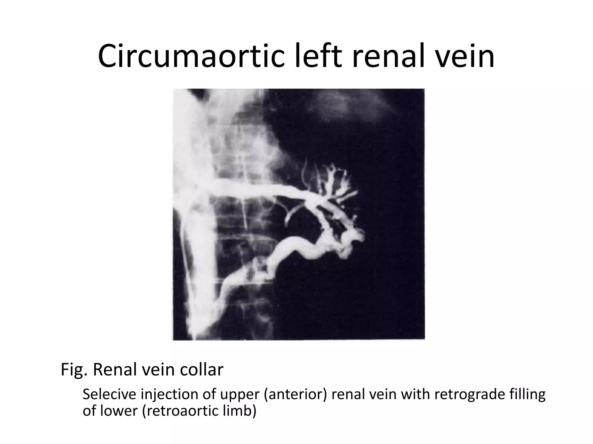 Normal anatomy and congenital anomalies of vena cavae | PPTX