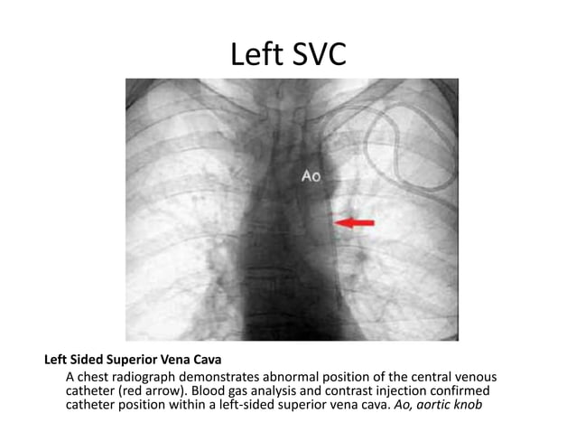 Normal anatomy and congenital anomalies of vena cavae | PPTX ...