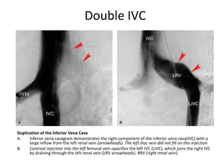 Normal anatomy and congenital anomalies of vena cavae | PPT