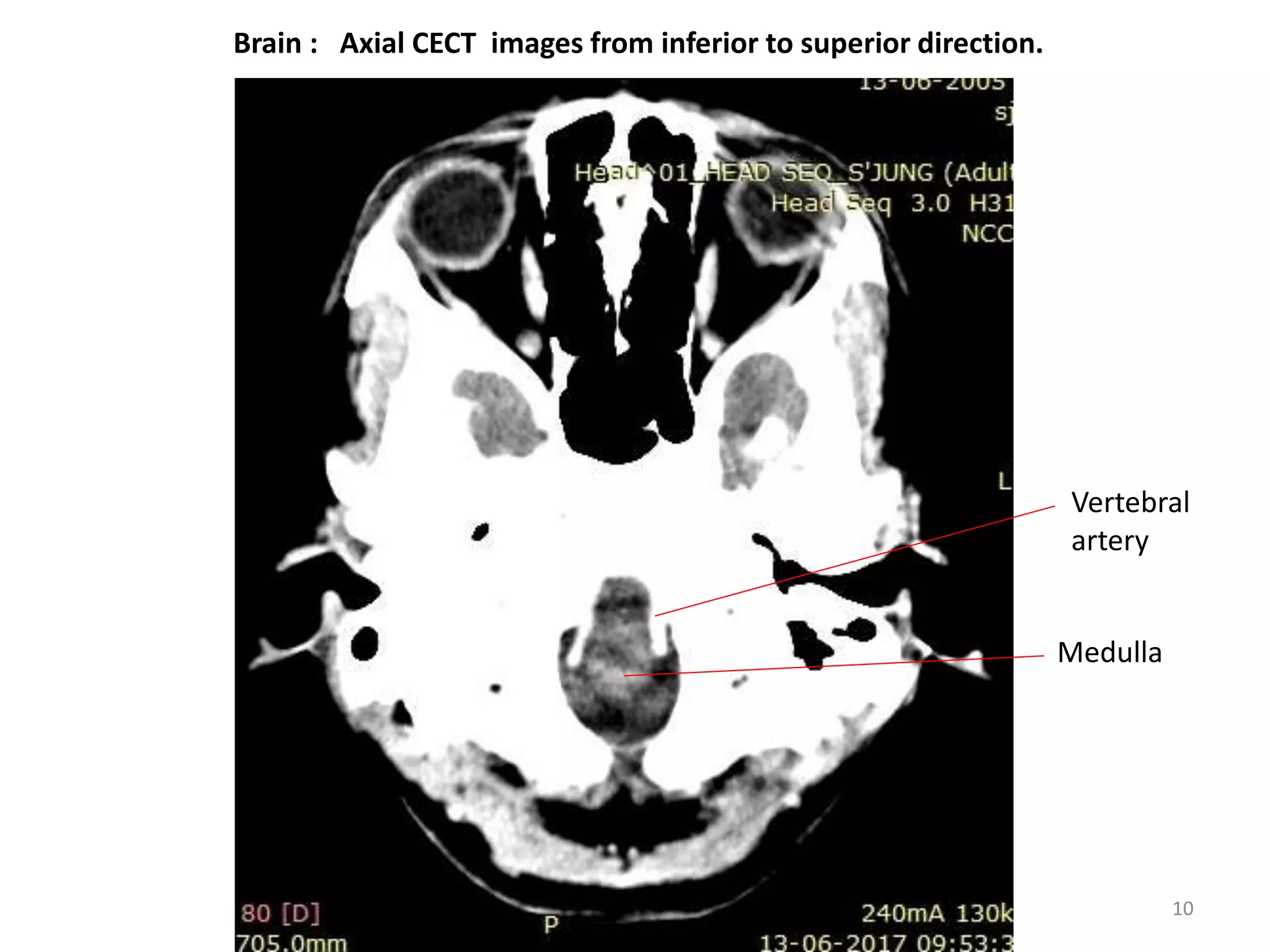 Normal anatomy of brain on CT and MRI | PPTX | Pregnancy | Reproductive ...