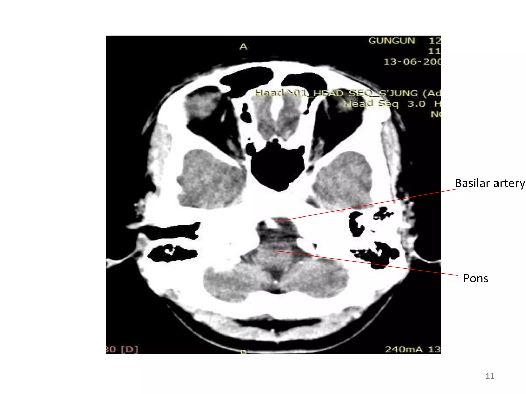 Normal Anatomy Of The Brain On Ct And Mri With A Few Normal Variants