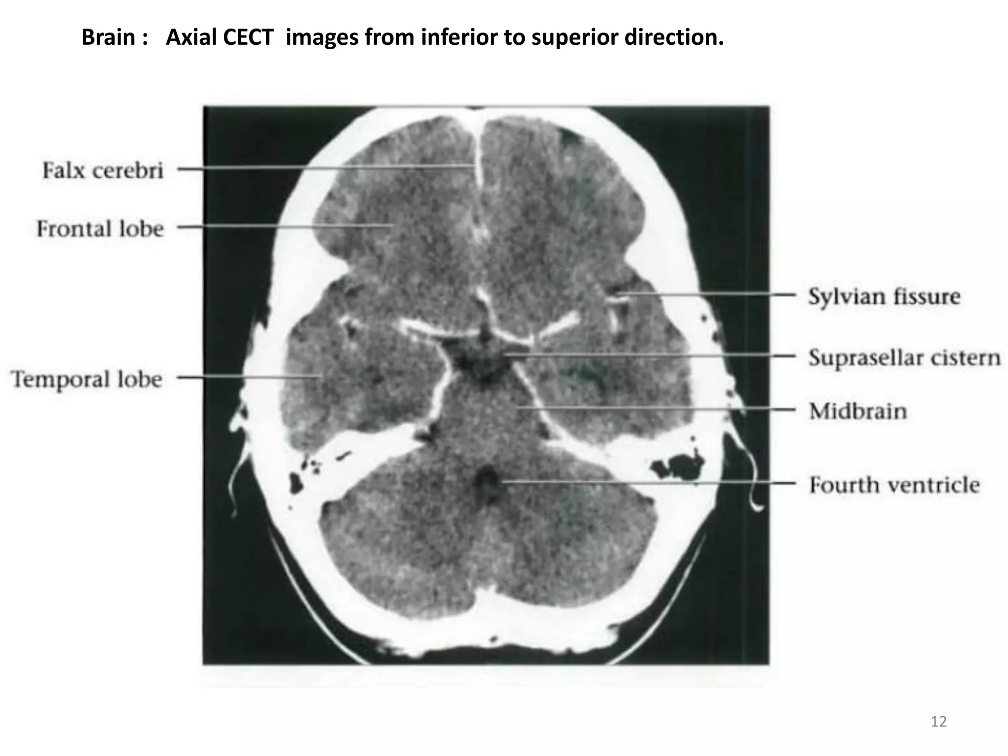 Normal anatomy of brain on CT and MRI | PPTX